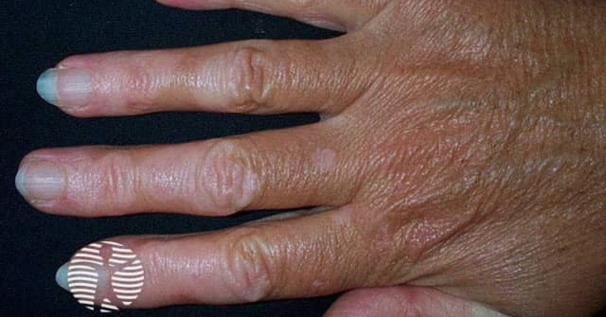 DermNet® - Acral vitiligo image