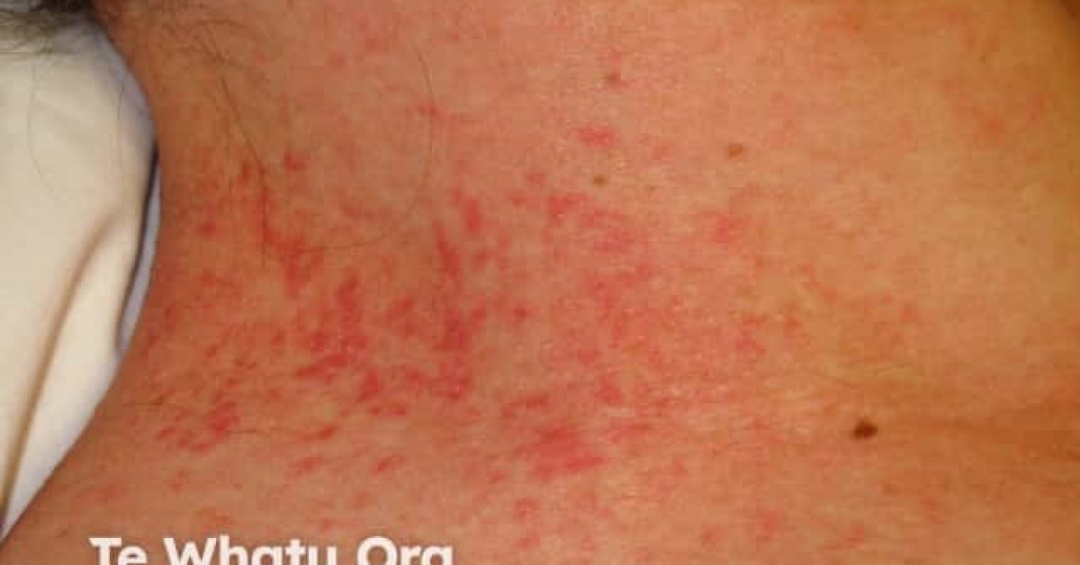 DermNet® - Dowling-Degos disease image