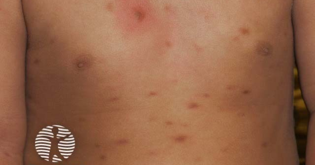 Diffuse Cutaneous Mastocytosis Image Diffuse Cutaneous Mastocytosis Image