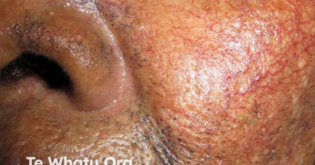 Ochronosis following long-term use of hydroquinone image