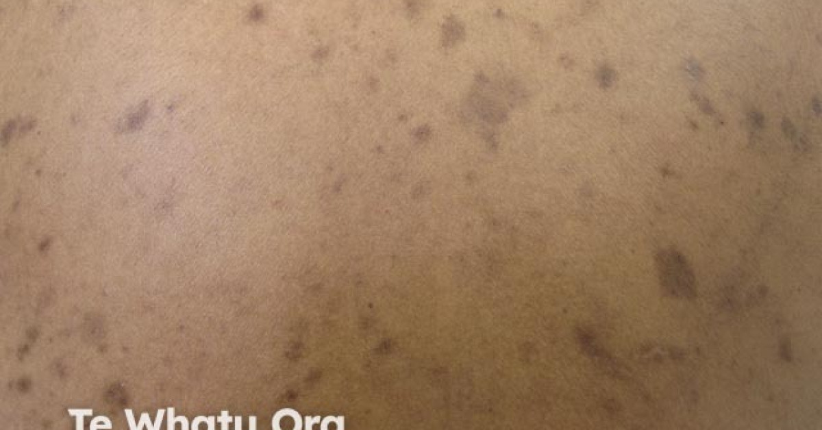 Postinflammatory pigmentation. Healed eczema image