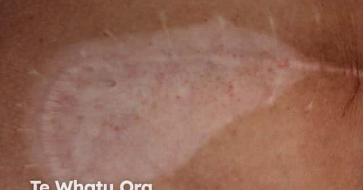 Koebnerised vitiligo image