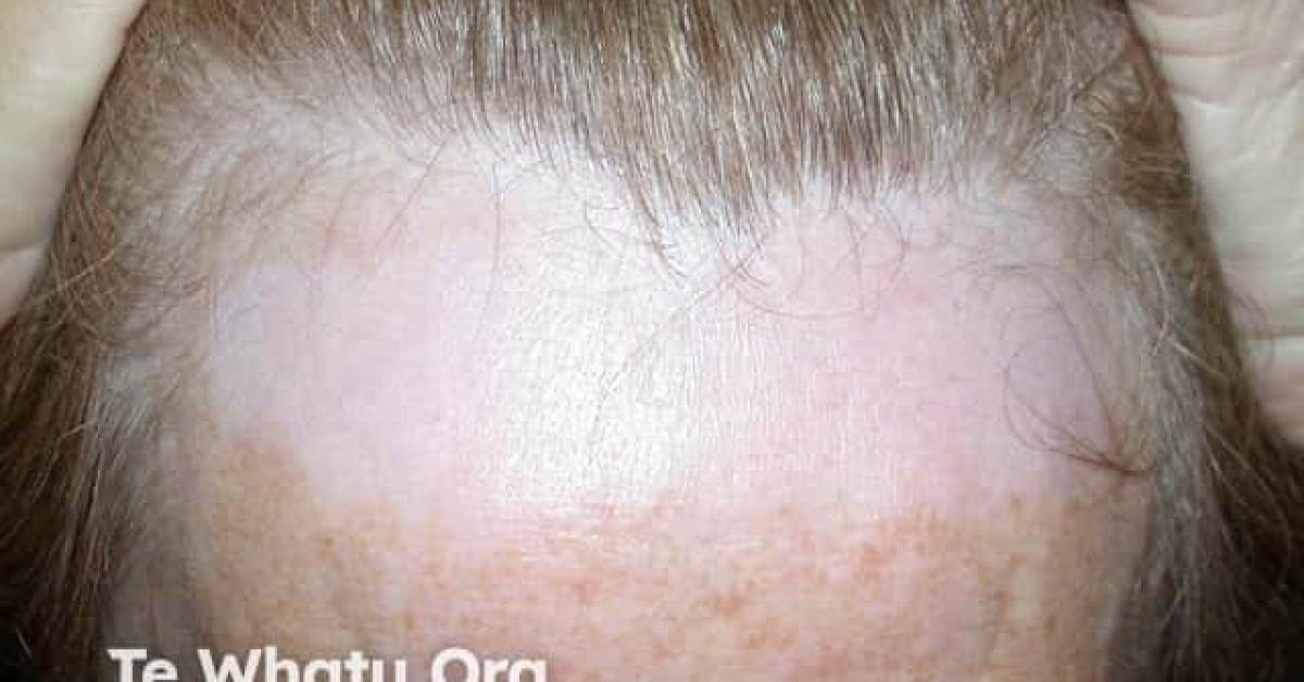 Vitiligo image