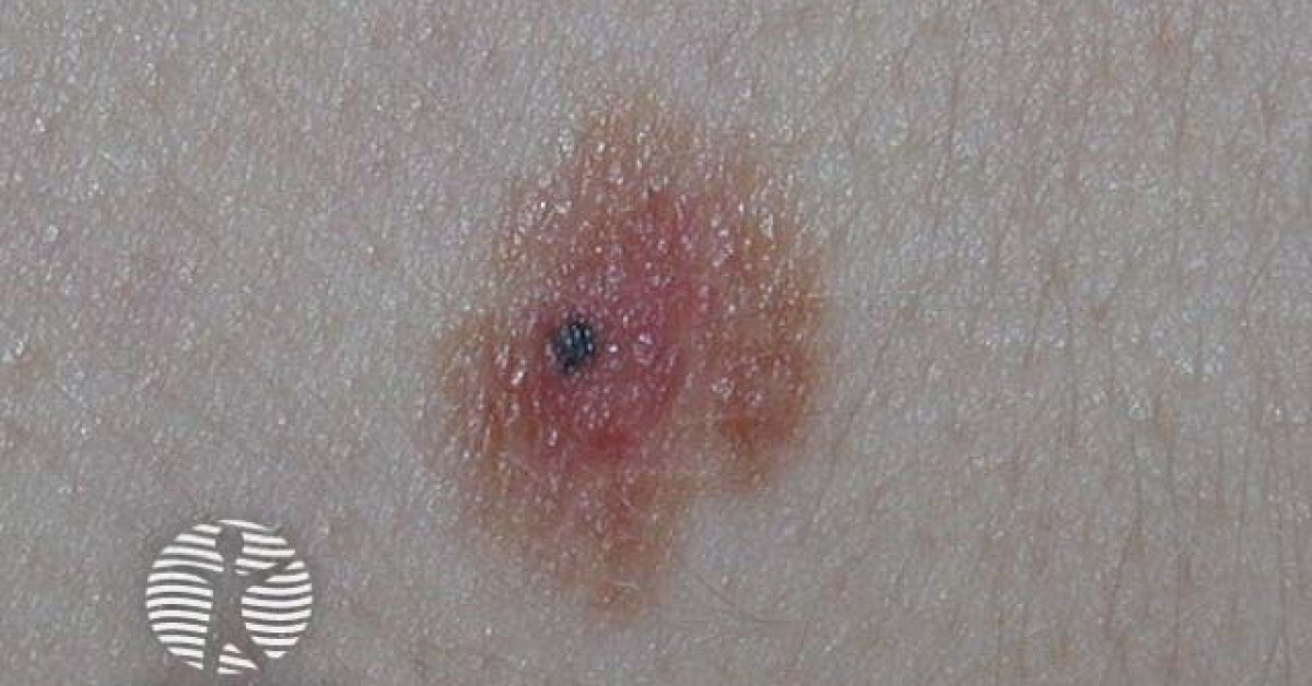 combined naevus image