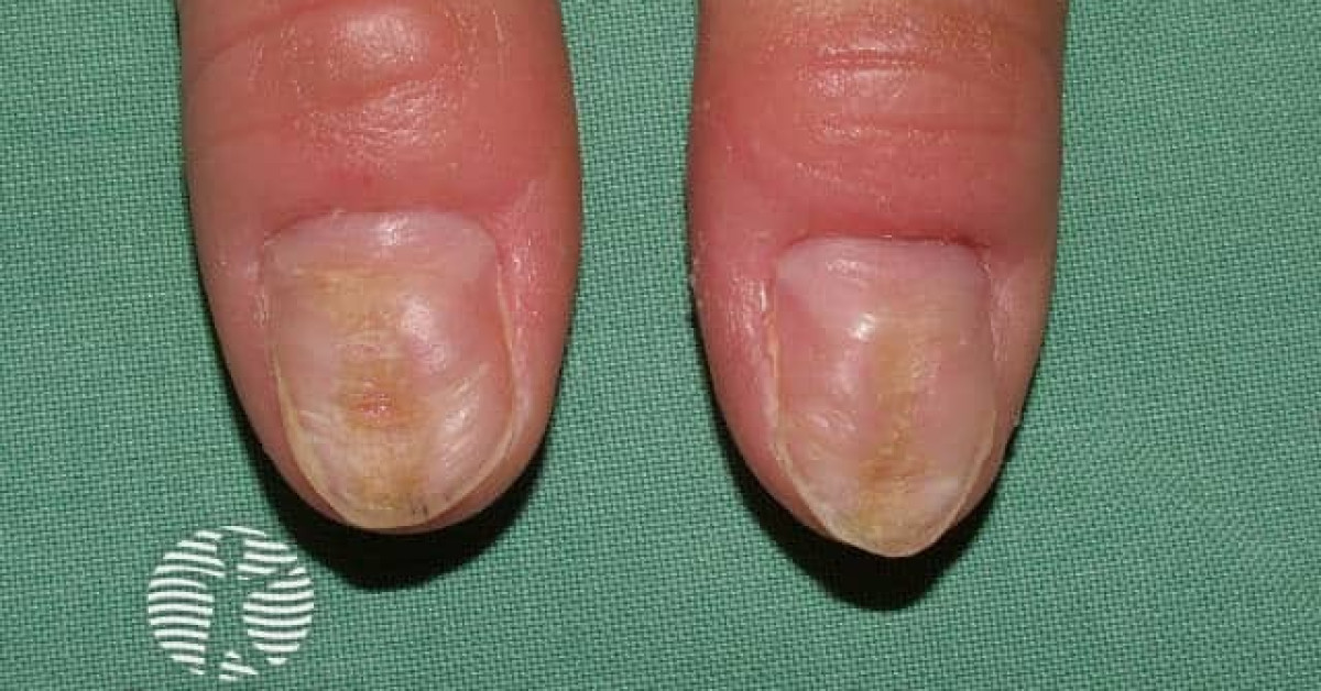 Nail dystrophy due to compulsive picking image
