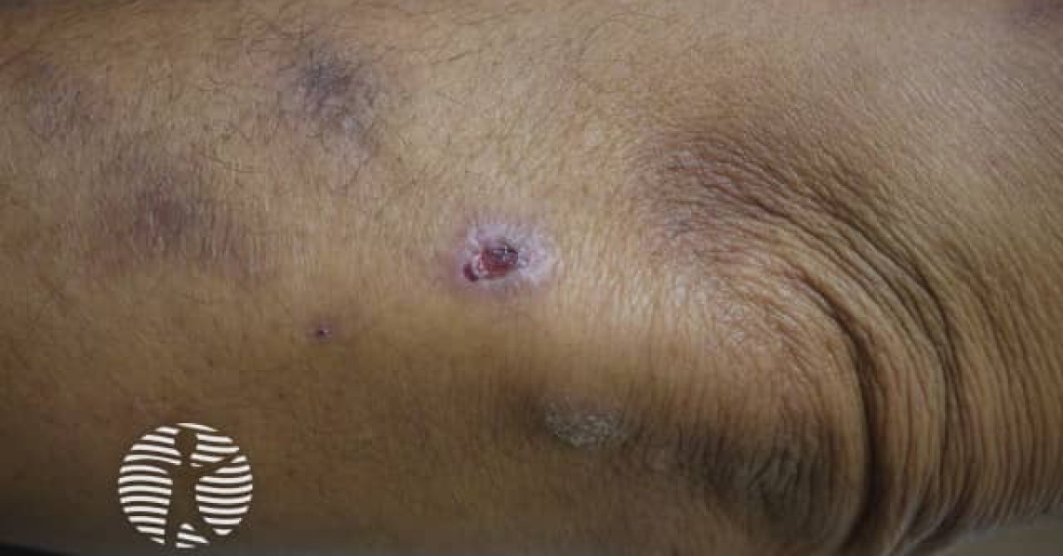 Compulsive picking image