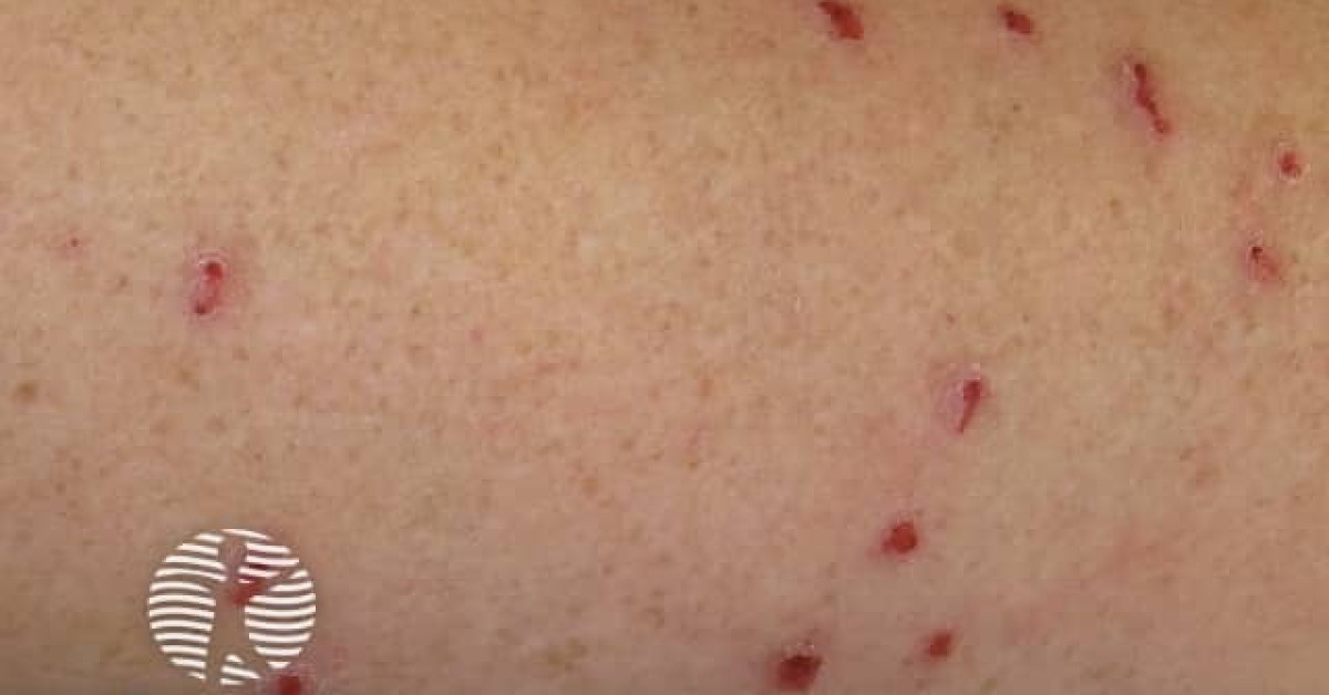 Compulsive picking image