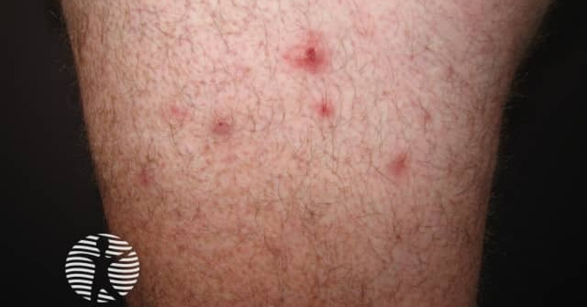 Compulsive picking image