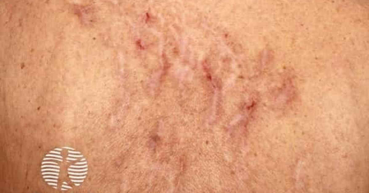 Compulsive picking image