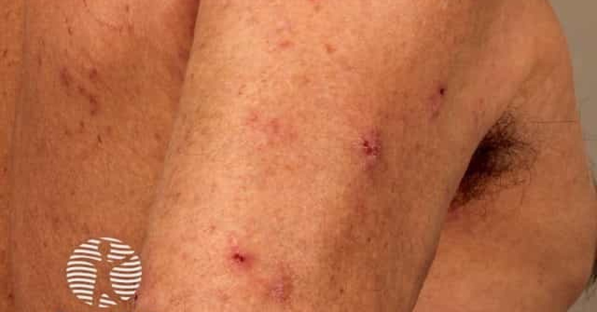 Compulsive picking image