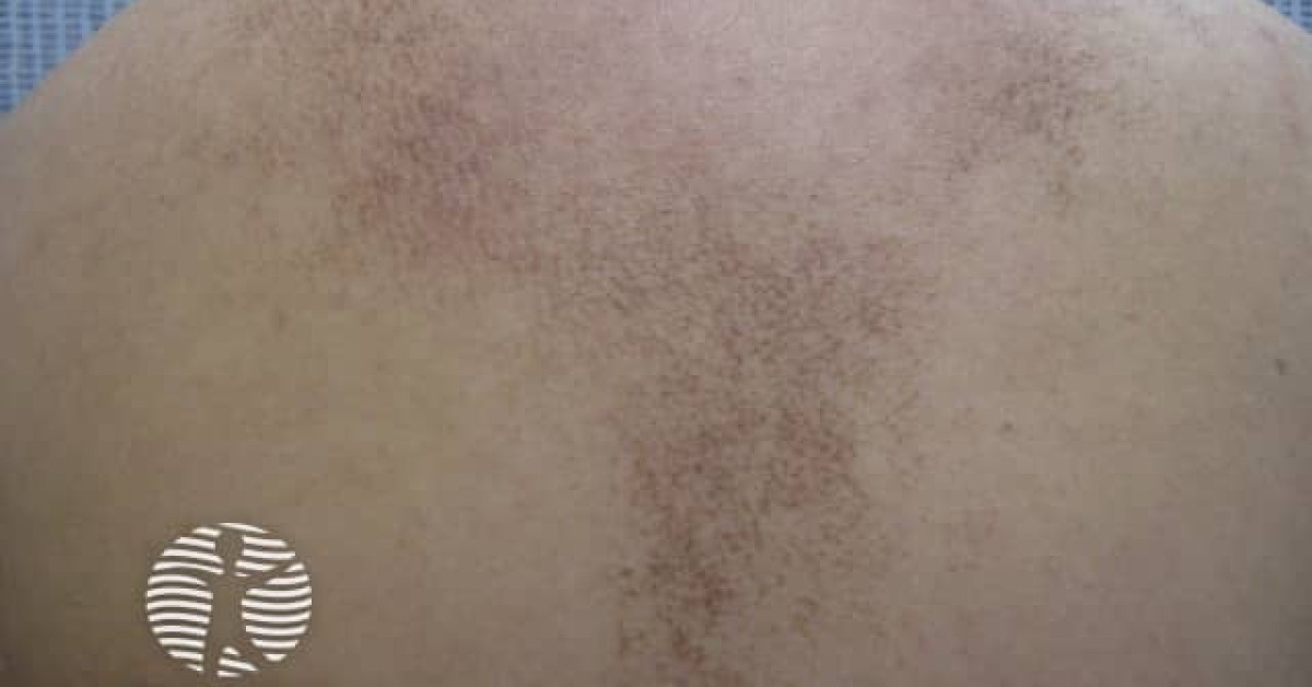 Confluent and reticulated papillomatosis image