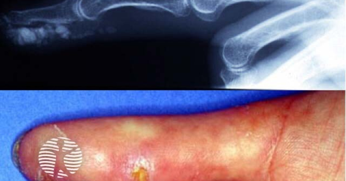Calcinosis cutis in systemic sclerosis image