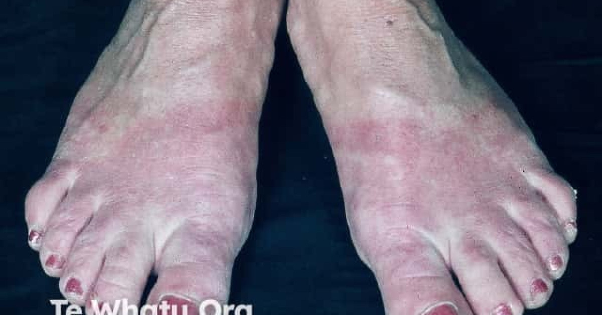 Contact dermatitis image