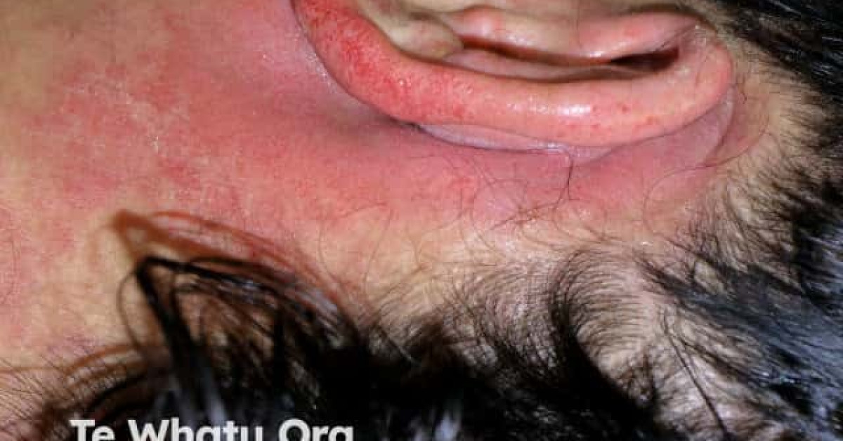 Allergic contact dermatitis to hair dye image