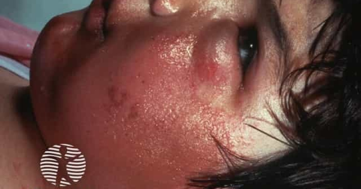 Severe contact allergic dermatitis in a child image