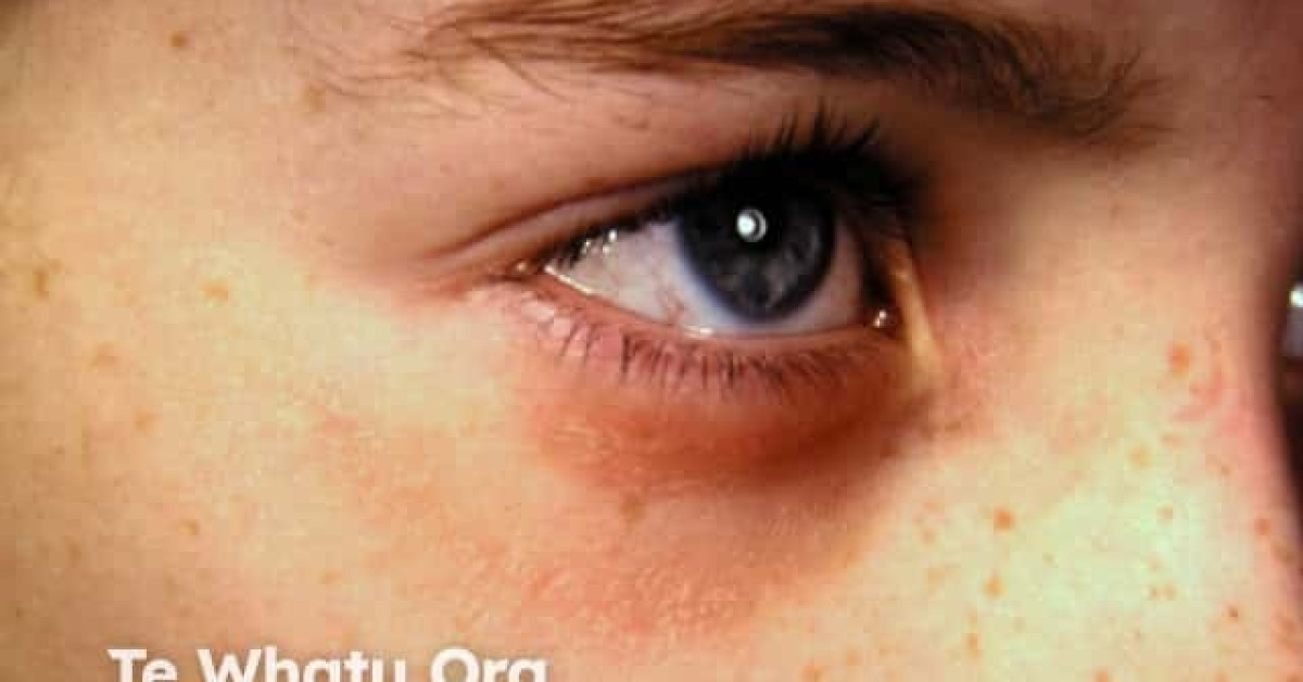 Contact allergic dermatitis in child image