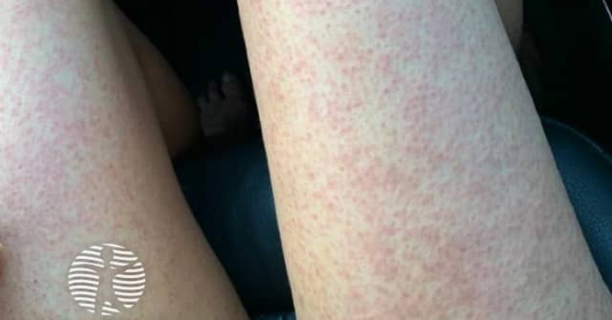 Suspected COVID-19 rash image