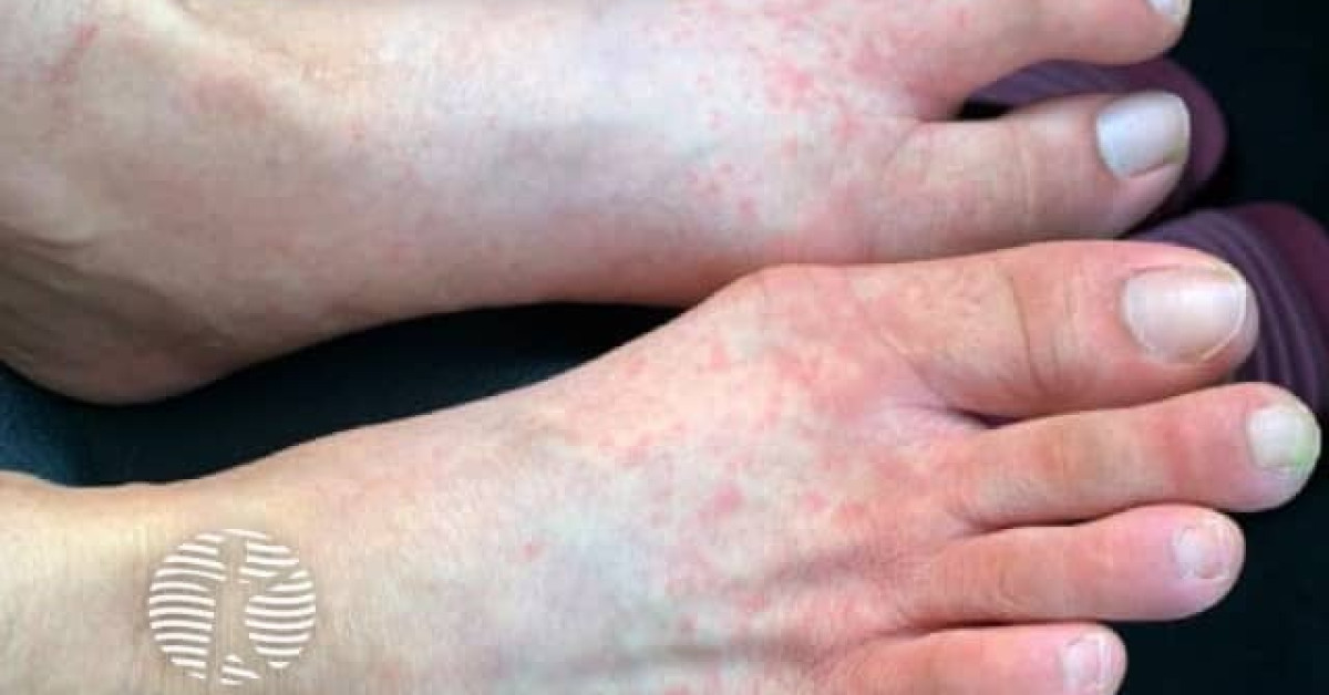 Suspected COVID-19 rash image