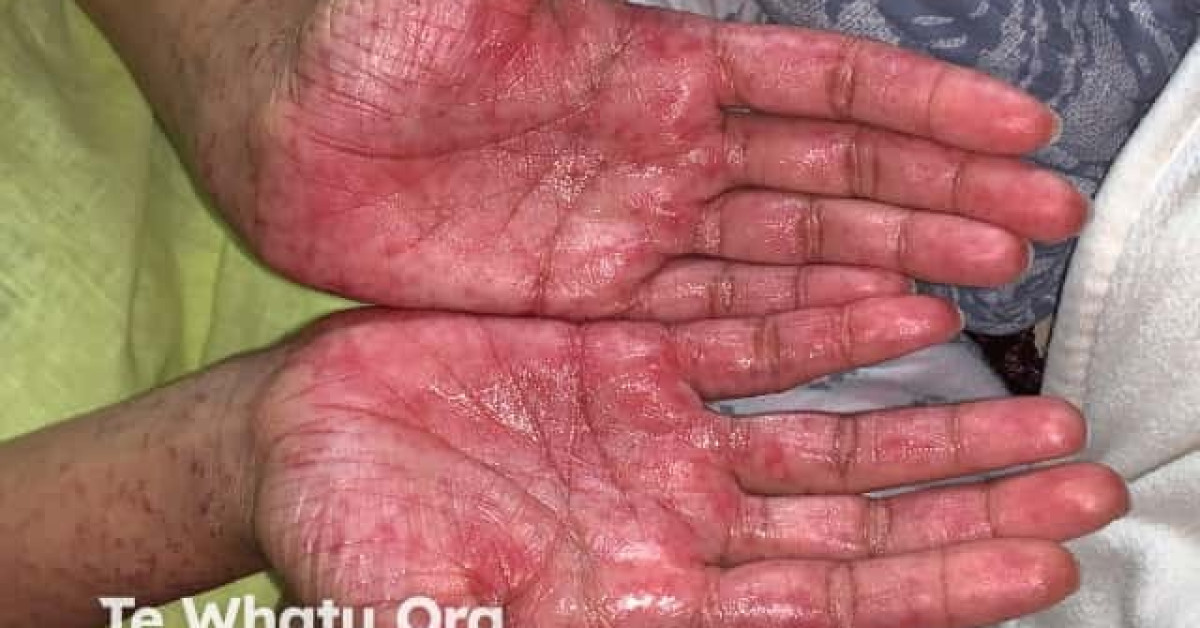 Suspected COVID-19 rash image