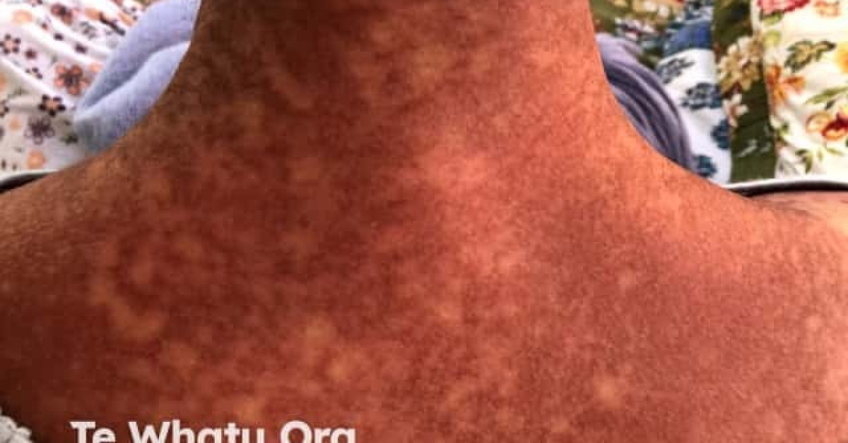 Suspected COVID-19 rash image