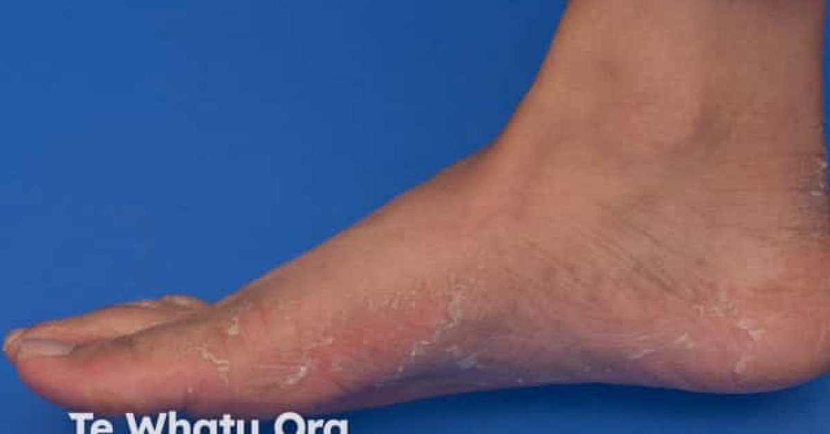 Postinflammatory desquamation image