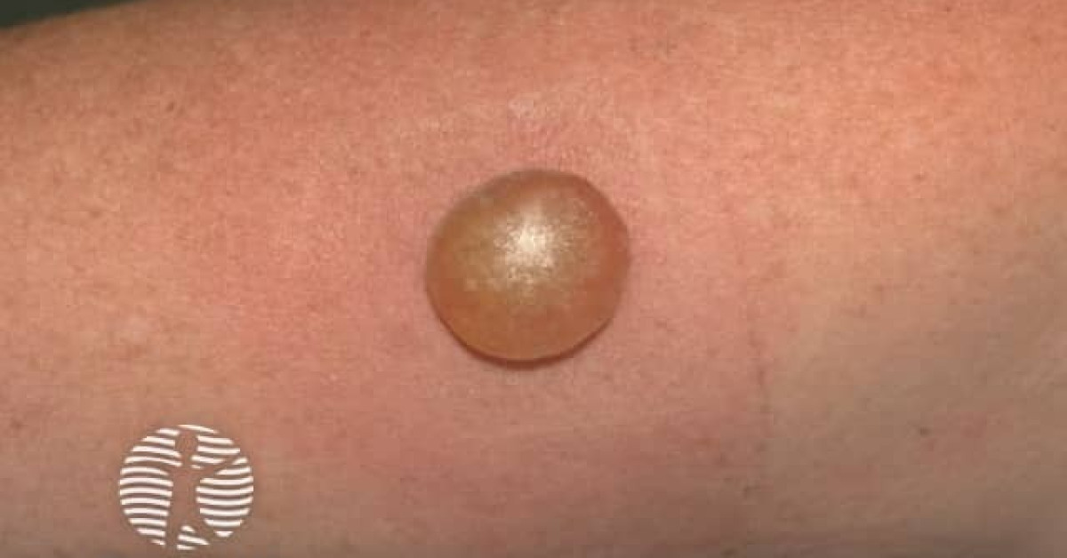 Cryotherapy infected blister image