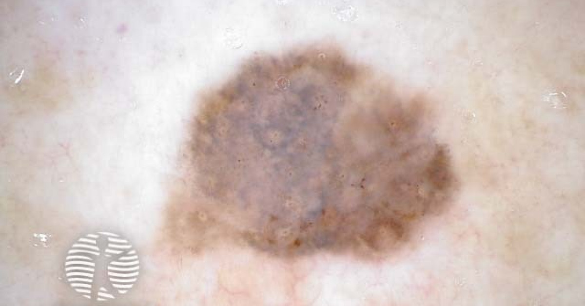 Melanoma in situ, nonpolarised dermoscopy view image