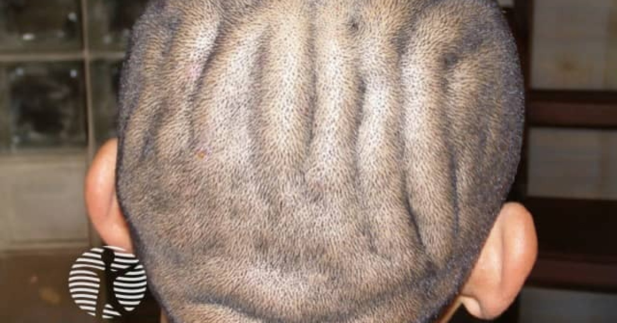 Cutis verticis gyrata image