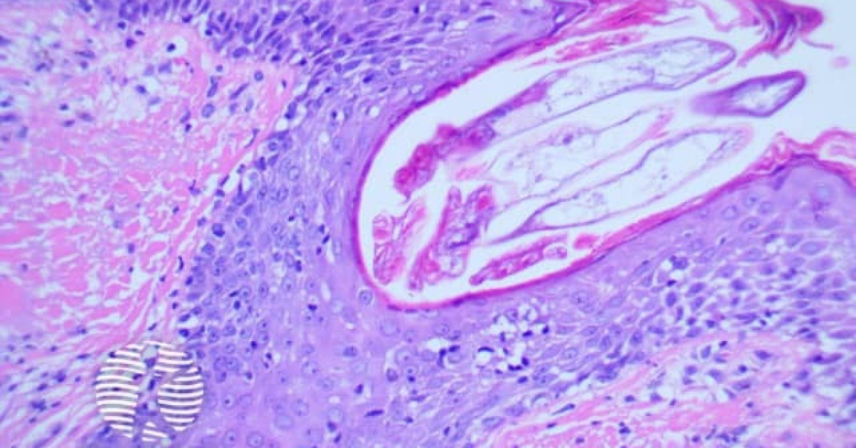 DermNet® - Demodex mite histology x200 image