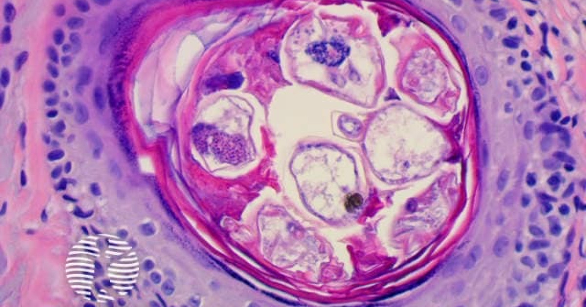 Demodex mite histology x400 image