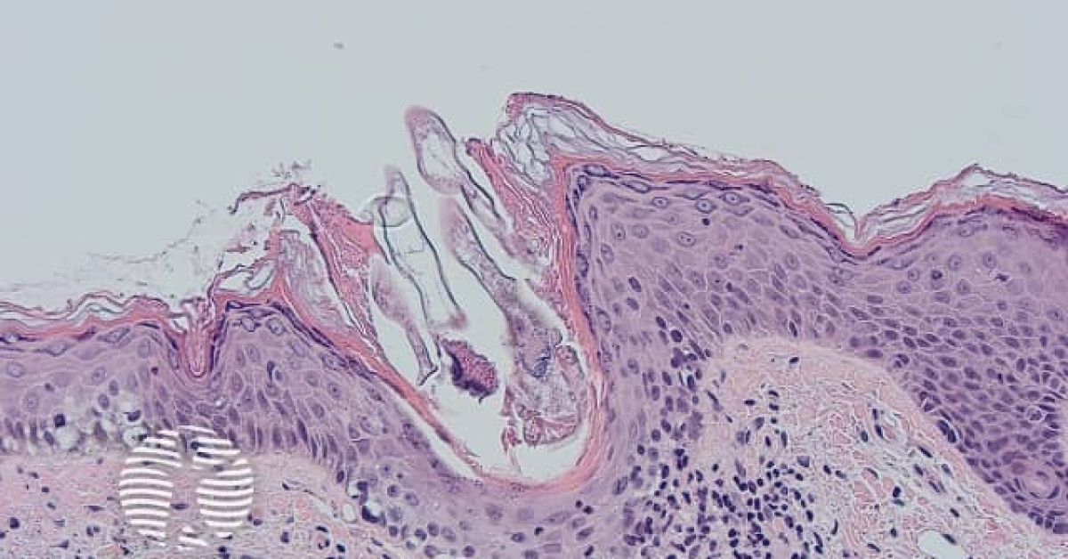 demodex image