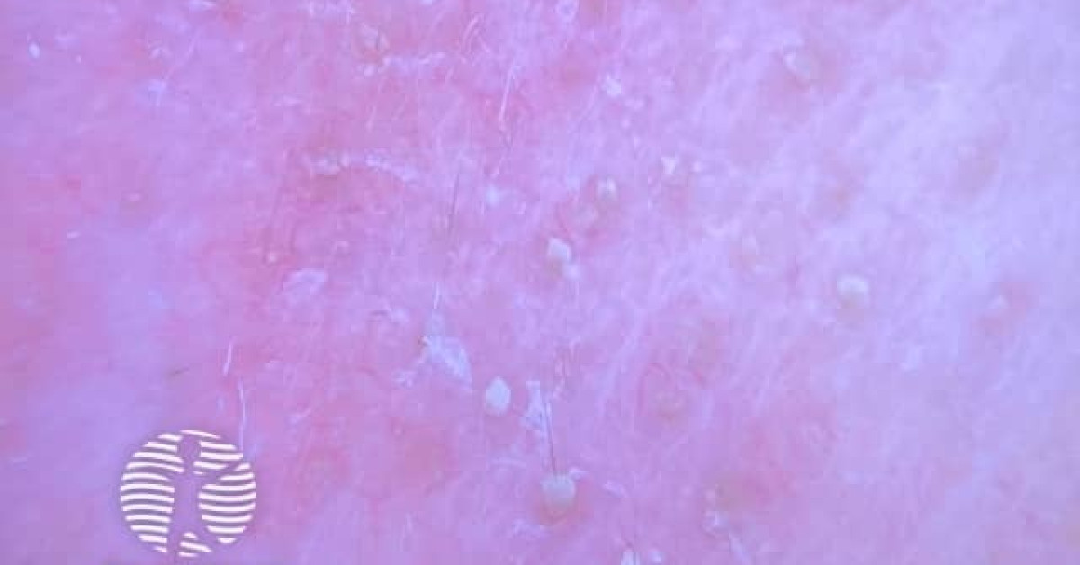 Dermoscopy of demodicosis image