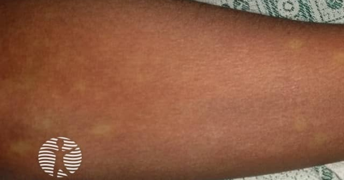Dengue rash image