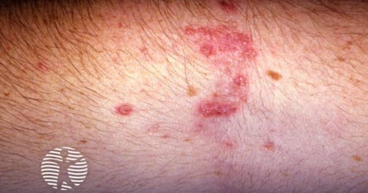 Elastosis perforans serpiginosa image