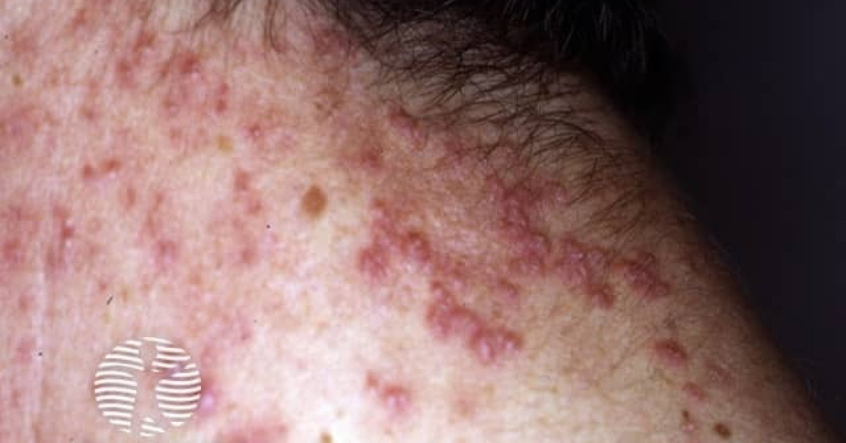 Elastosis perforans serpiginosa image