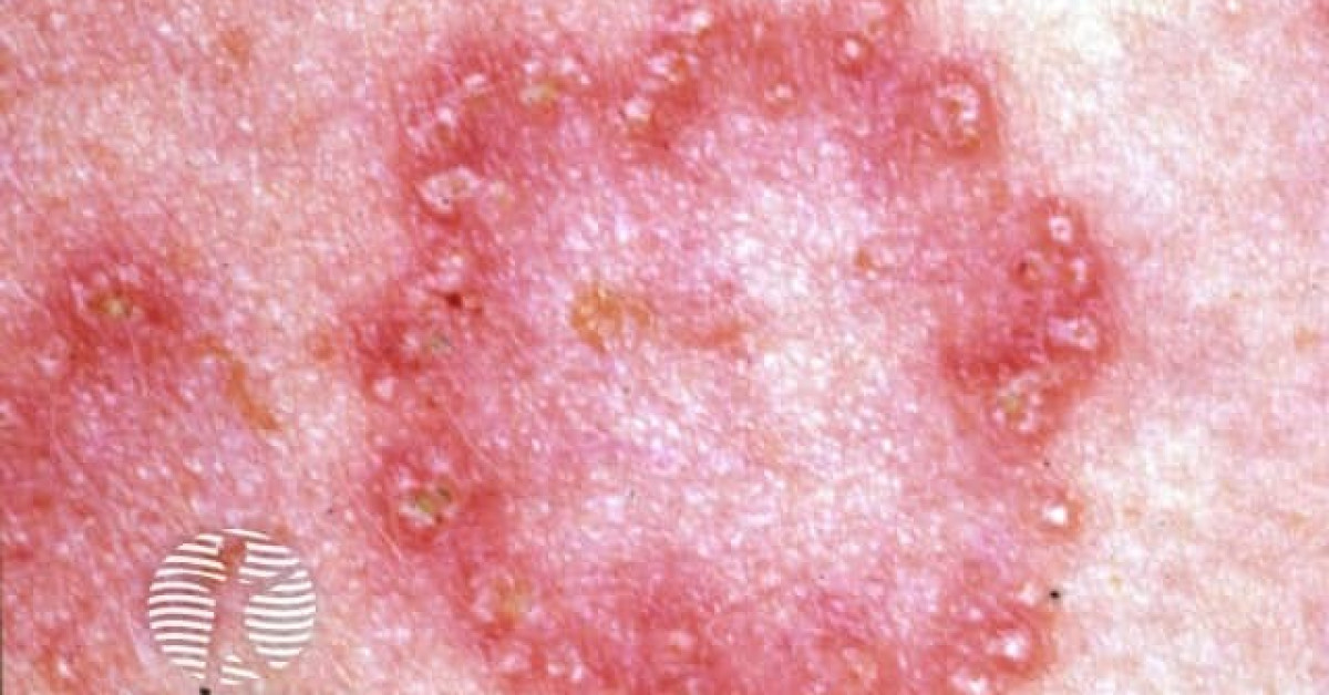 Elastosis perforans serpiginosa image