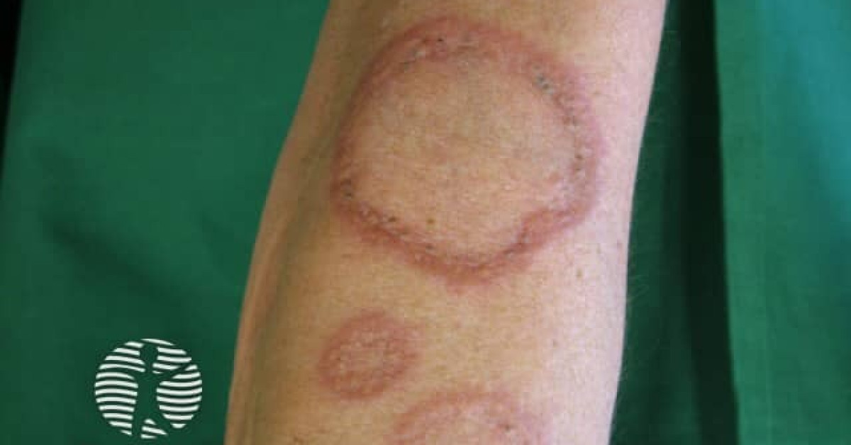 Granuloma annulare image