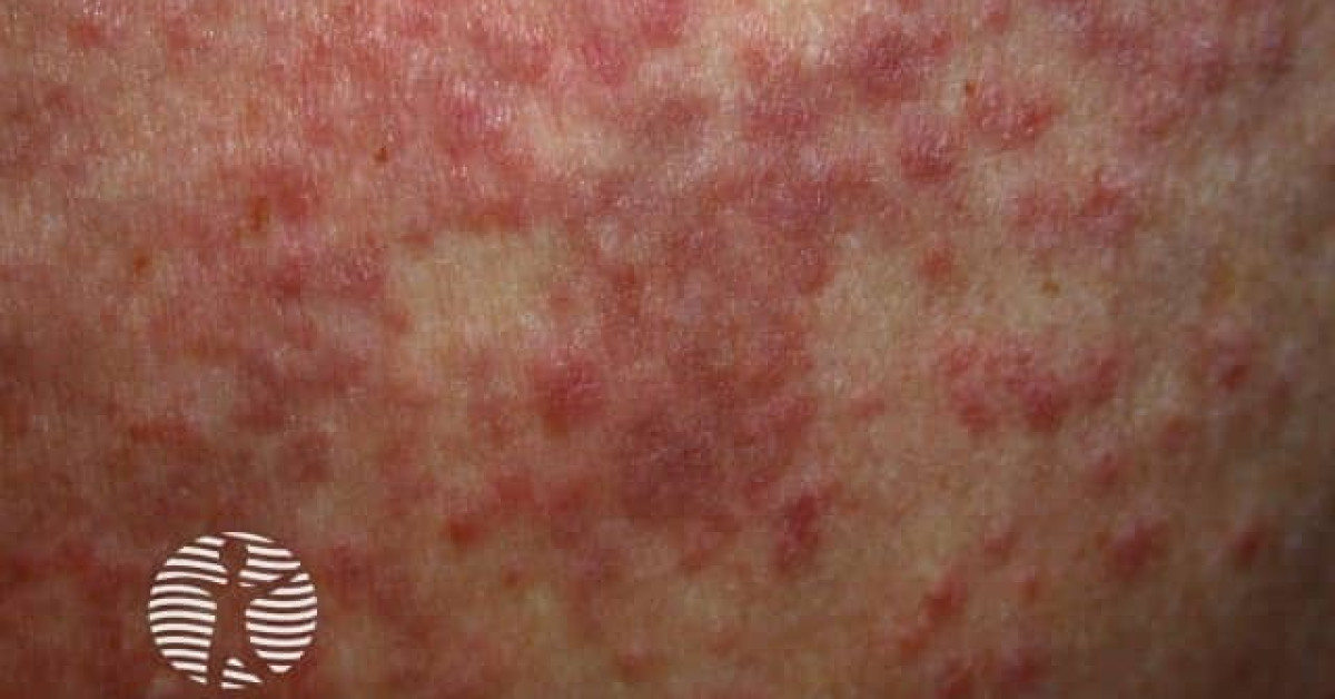 Granuloma annulare image