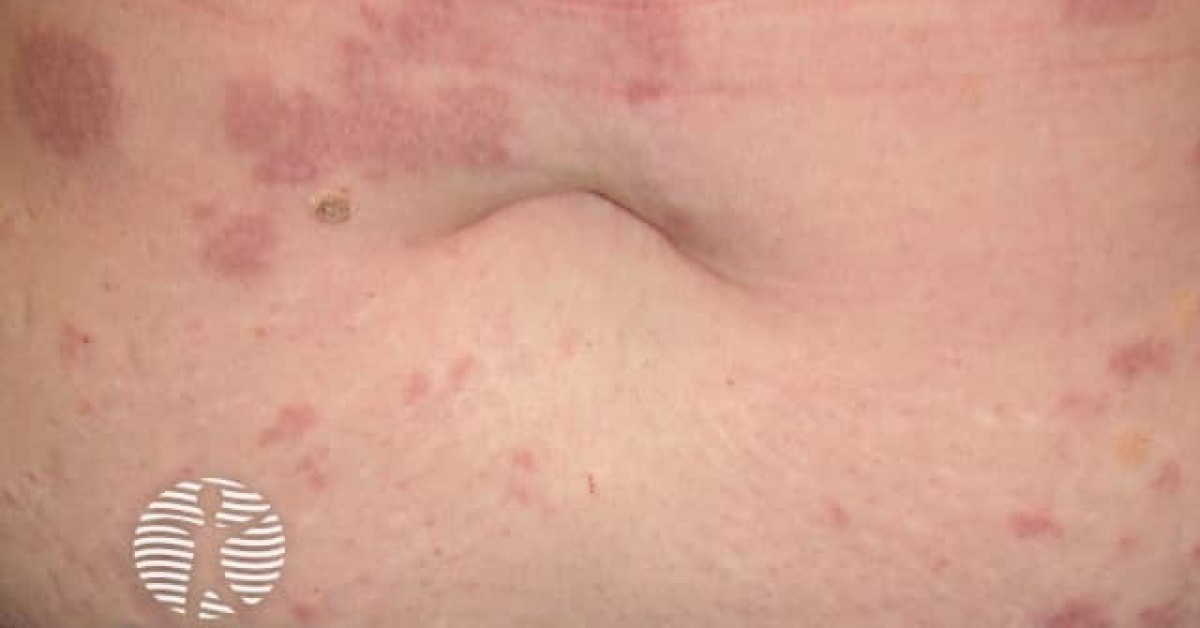 Granuloma annulare image