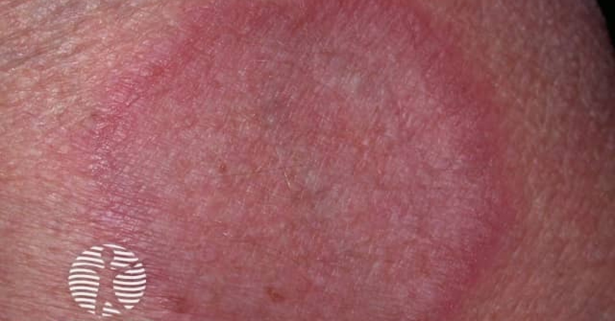 Granuloma Annulare Granuloma Multiforme Perri Dermatology