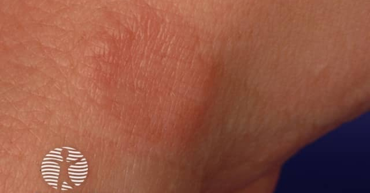 Granuloma annulare image