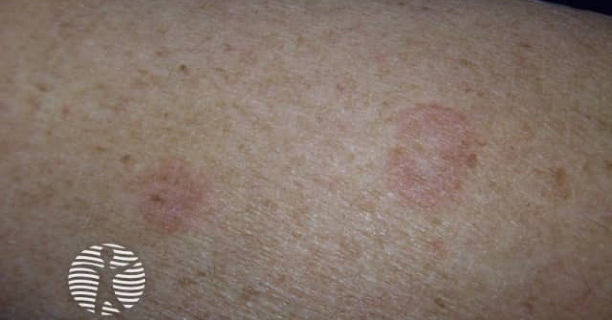 Granuloma annulare image