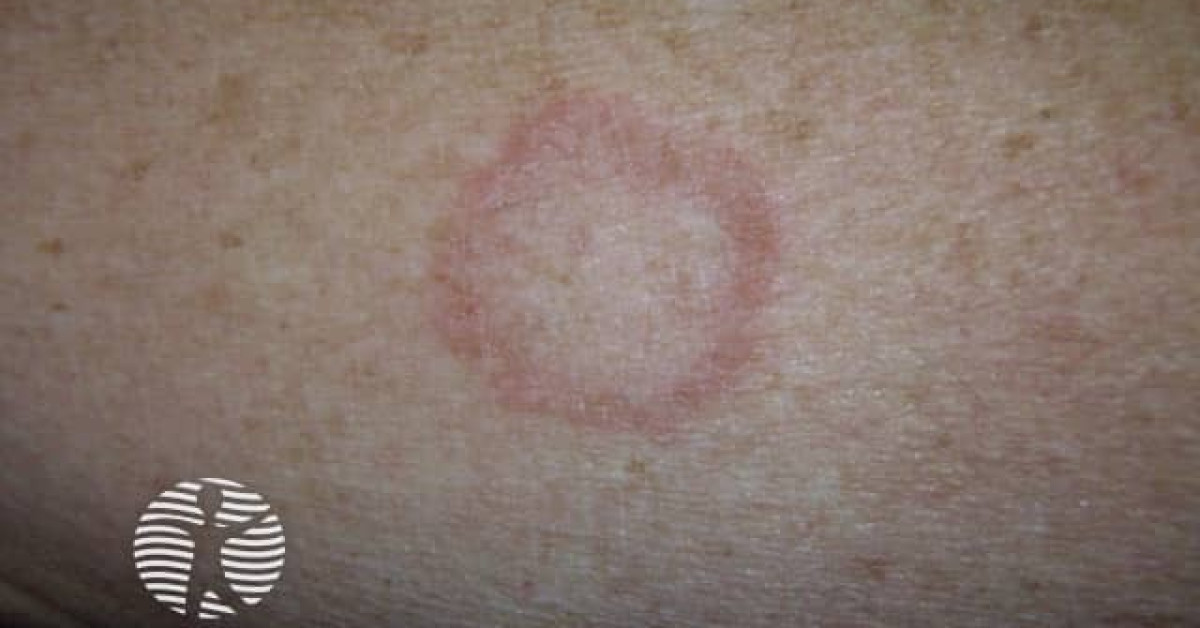 Granuloma annulare image