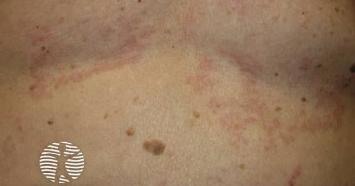 Granuloma annulare image