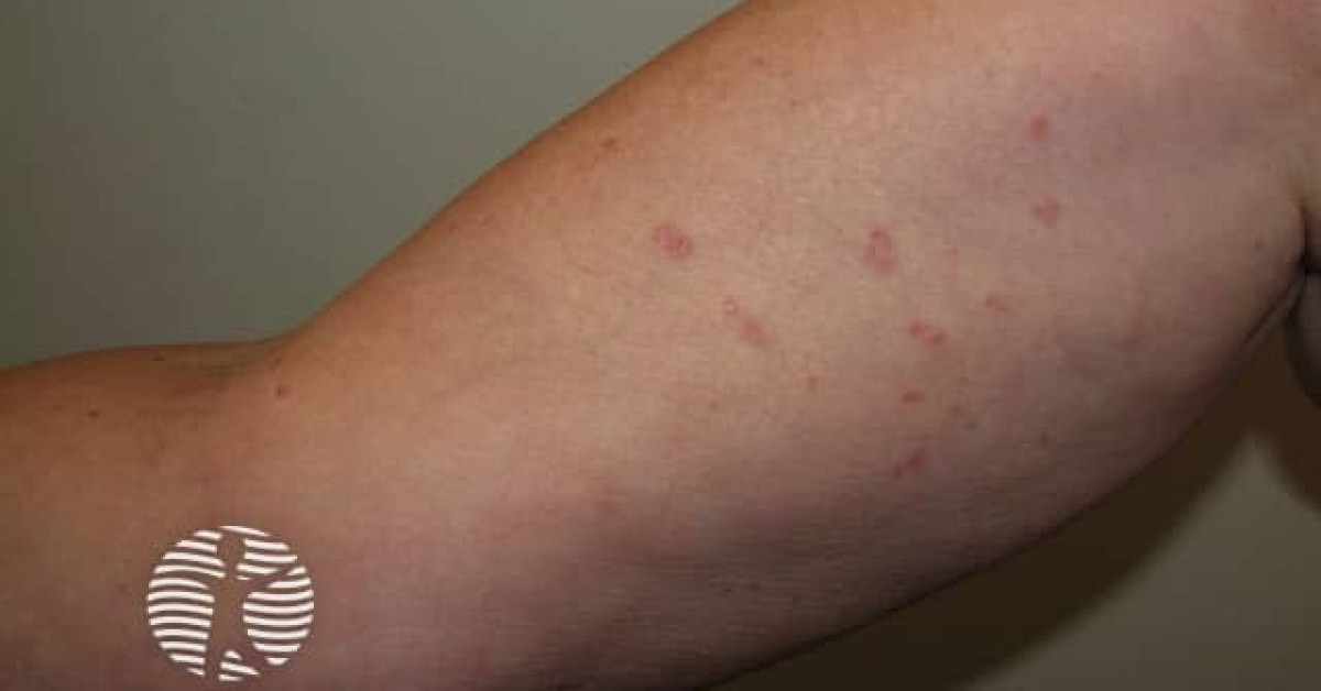 Granuloma annulare image