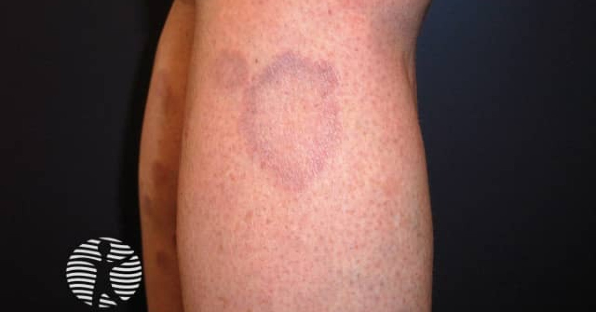 Granuloma annulare image