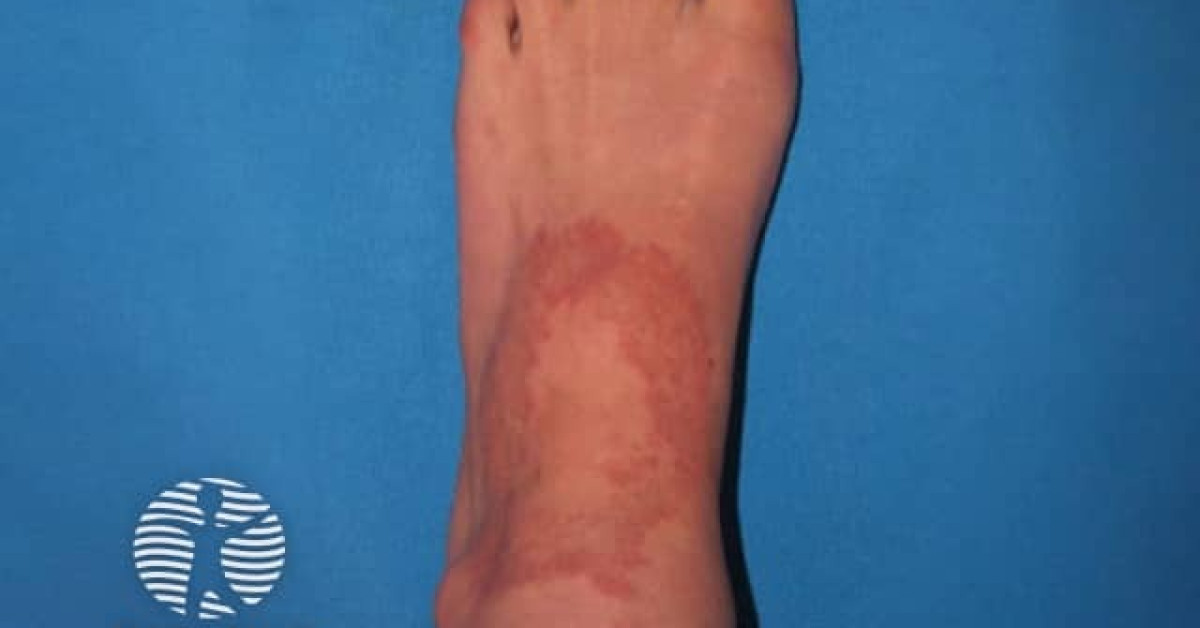 Granuloma annulare image