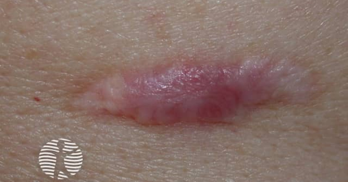 Hypertrophic scar image