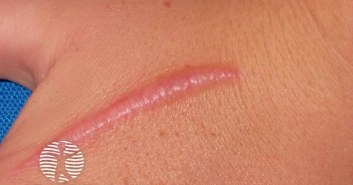 Hypertrophic scar image