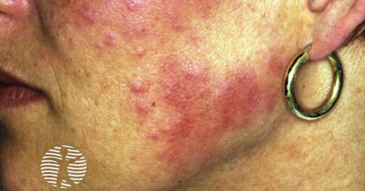 Jessner lymphocytic infiltrate image